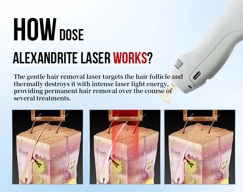 Newest Alexandrite Laser Hair Removal Long Pulse 1064nm Nd Yag 755nm ...
