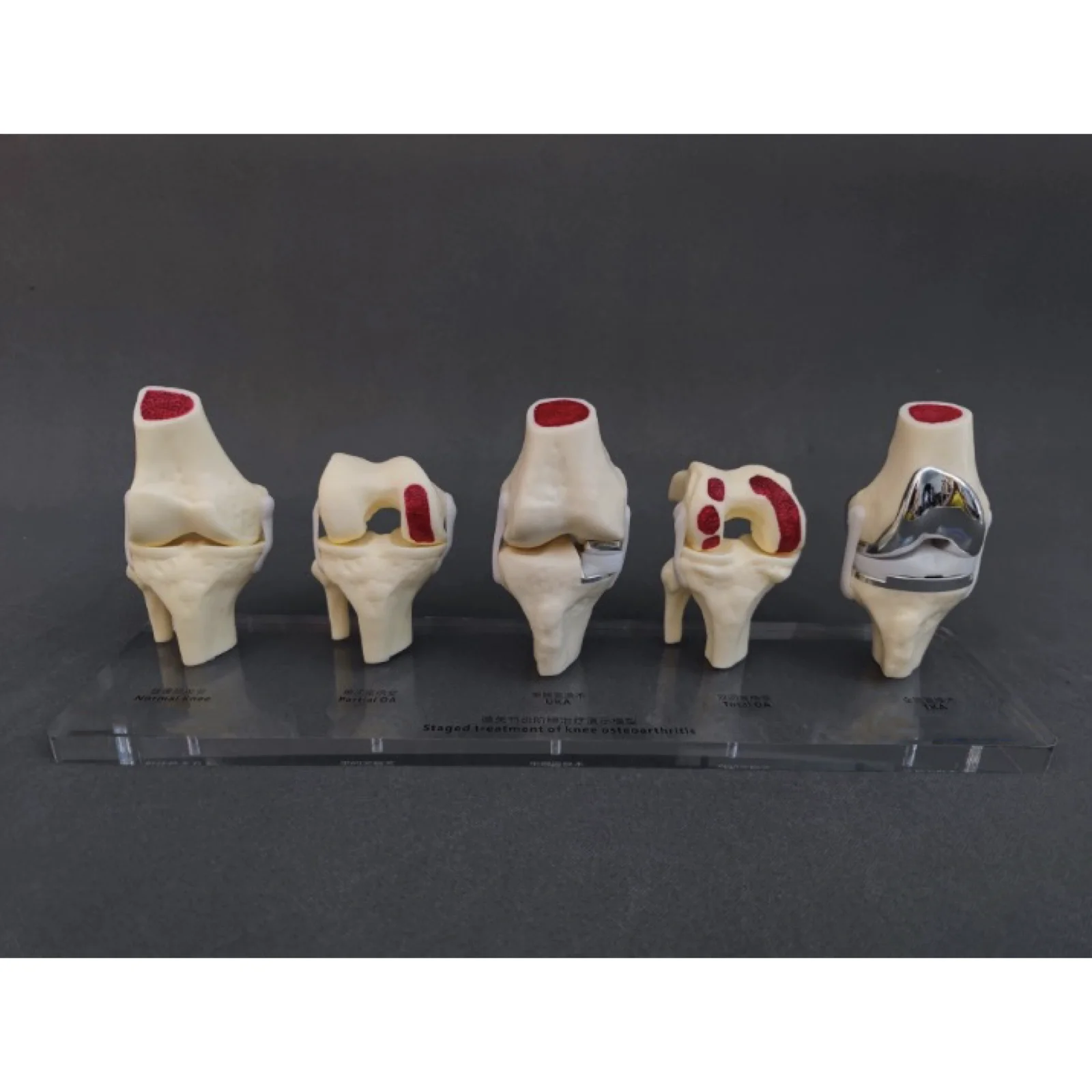 Kyrenmed Knee Osteoarthritis Staircase Treatment Model 5-stage Knee ...