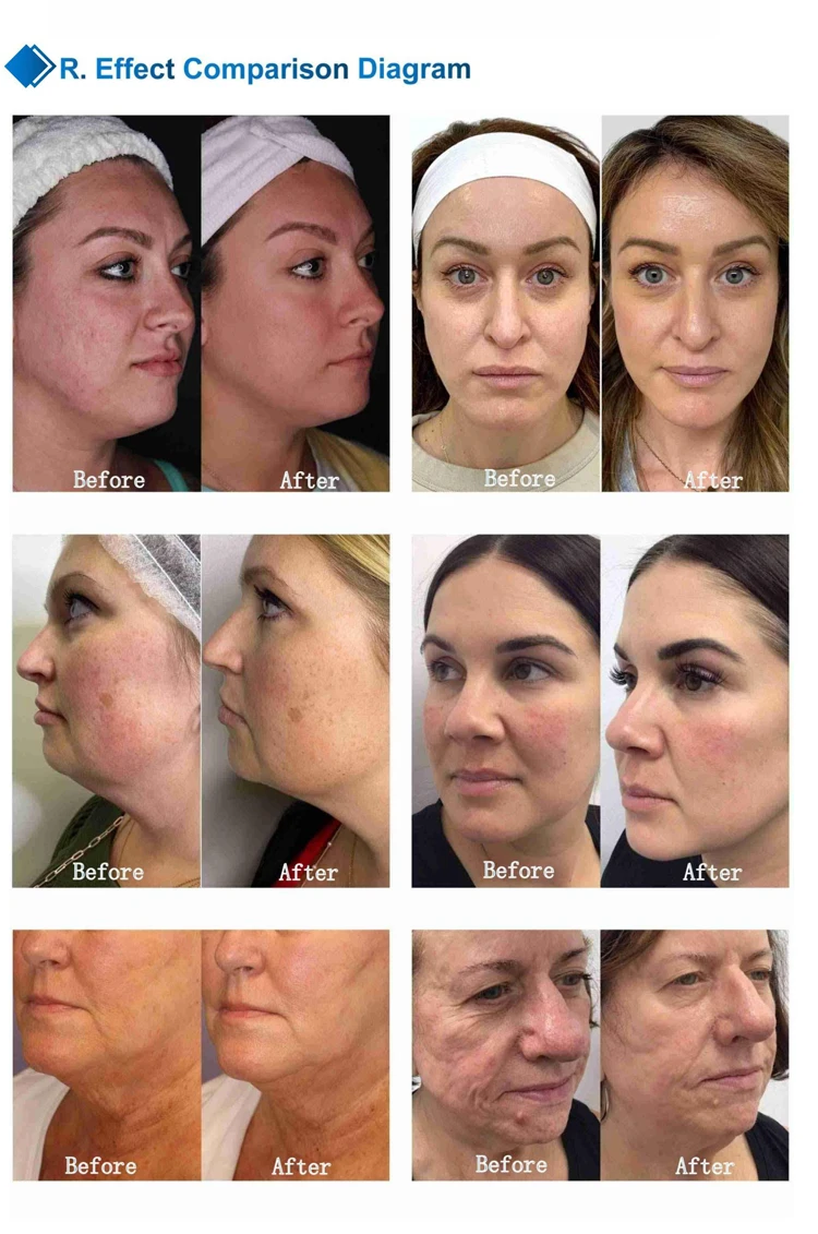 Medical Class Beauty Machines 2024 New Technologies Skin Rejuvenation ...