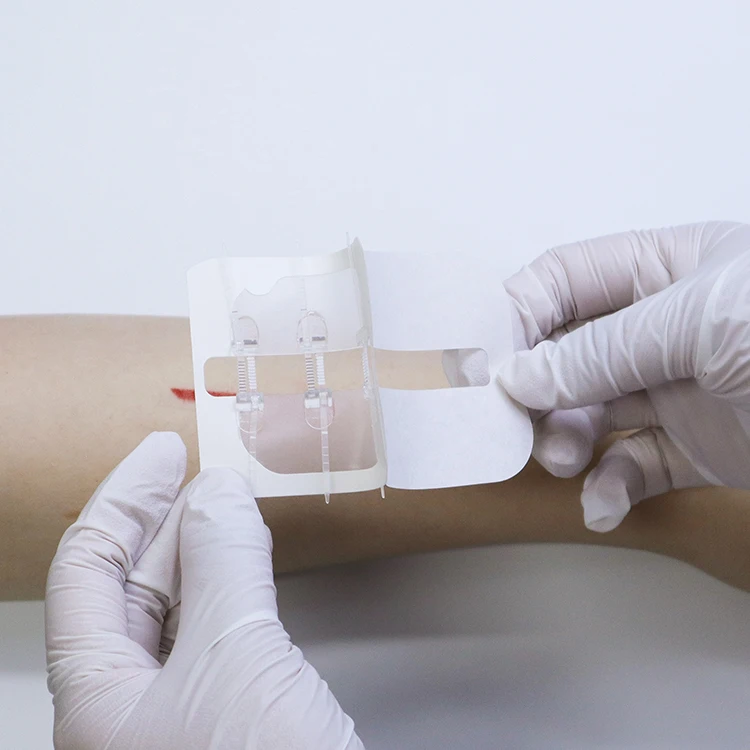 Trummed First Aid Suture Free Zip Lock Stitches Medical Wound Closure