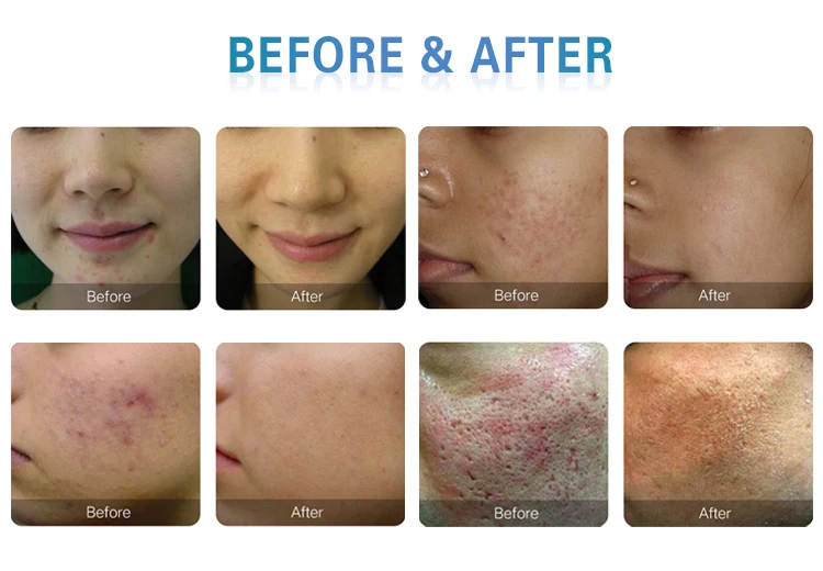 Rf Microneedling Machine Professional 2024 Rf Fractional Microneedling