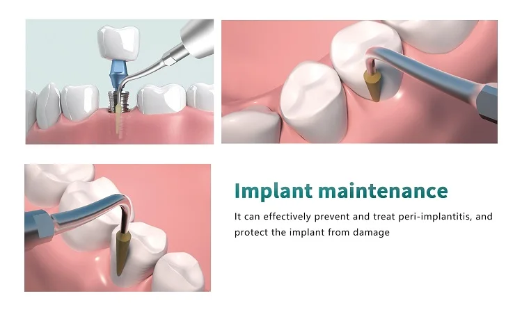 DQ80 Dental Ultrasonic Scaler - Efficient Periodontal Care