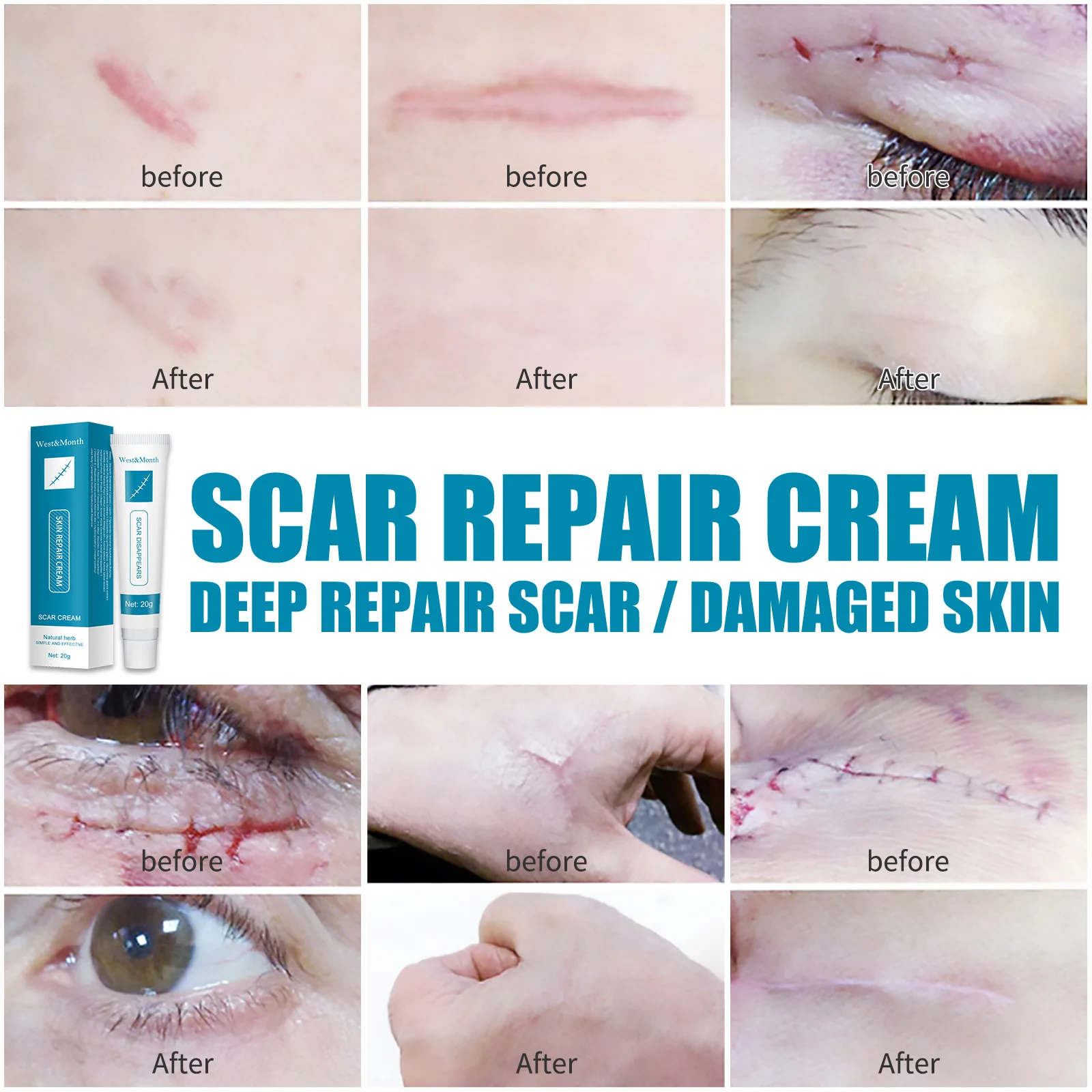 OEM Scar Removal Cream Pimples Stretch Marks Face Remove Acne Smoothing ...