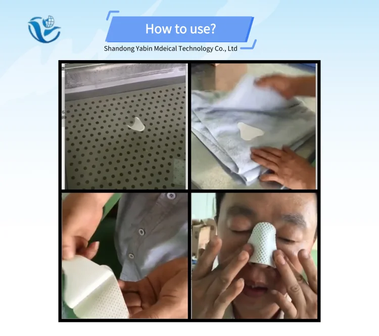 Thermoplastic Aquaplast Nasal Splint for Rhinoplasty Rehabilitation