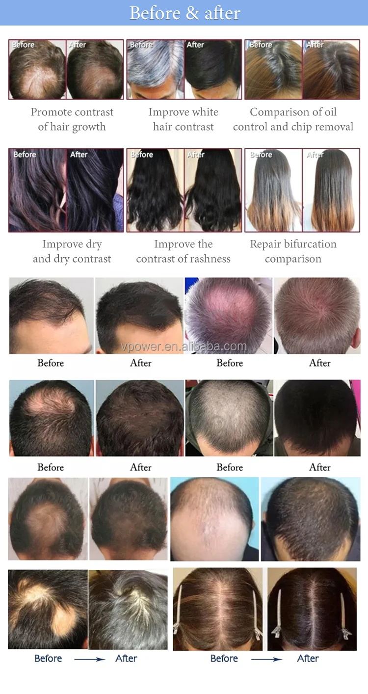 Dermasha 2024 Hair Growth Machine For Professionals Scalp Analyzer Skin ...