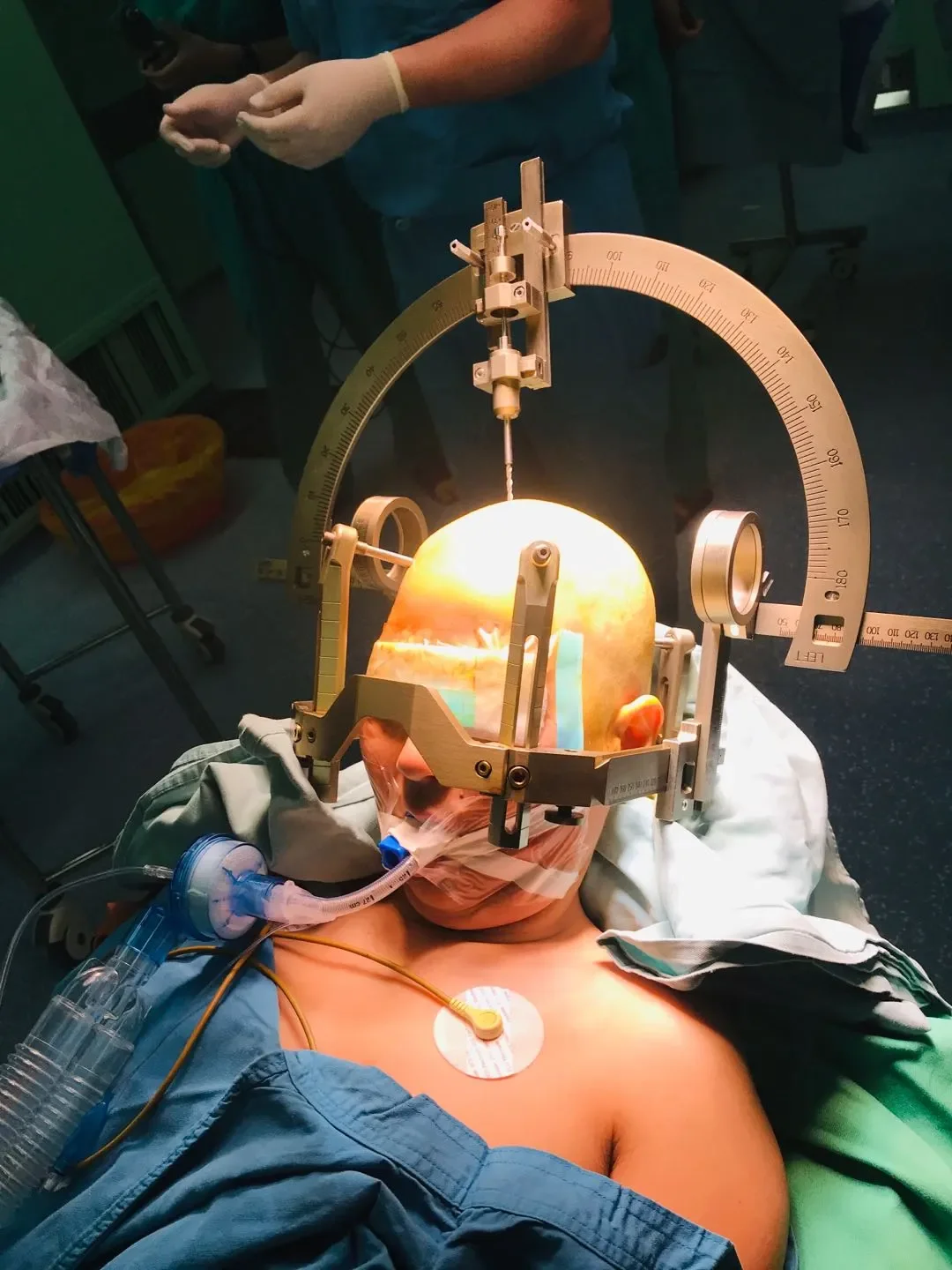 Stereotactic Frame System for Neurosurgery with Software - Reliable ...