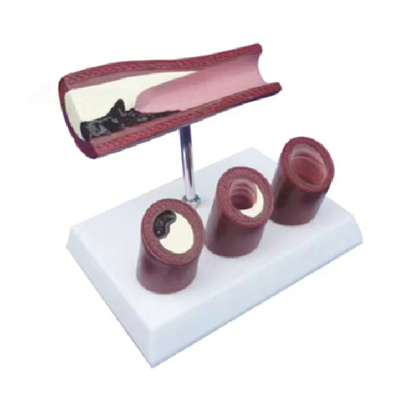 Medical Science Anatomy Artery Blood Vessel Medicine Pathology Thrombus ...