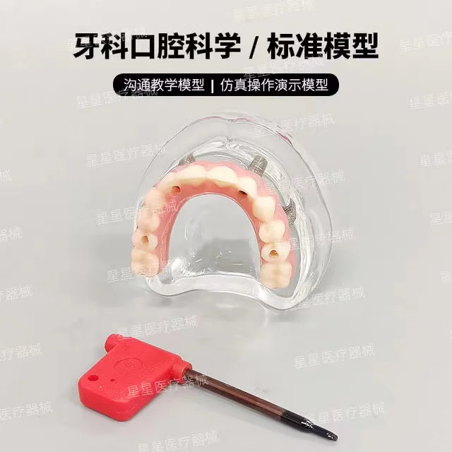Implant All on 4 Model with Resin Teeth - 4 Implants