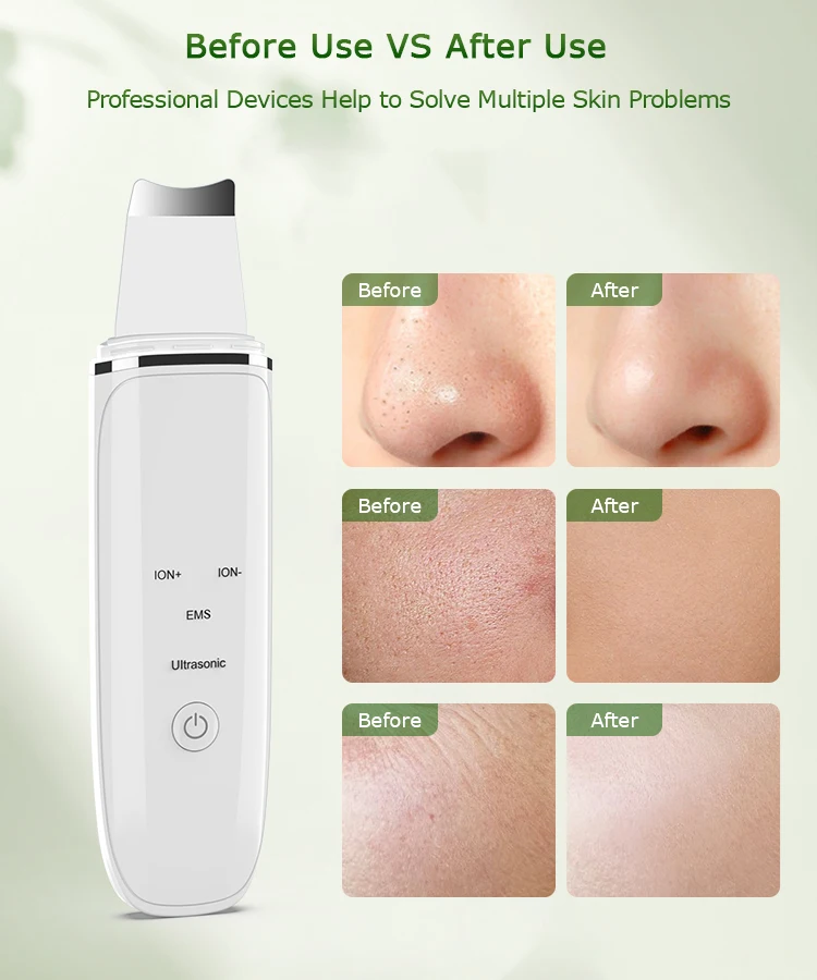 Ultrasonic Ion Therapy Face Skin Scrubber Facial Cleaner Cleansing ...