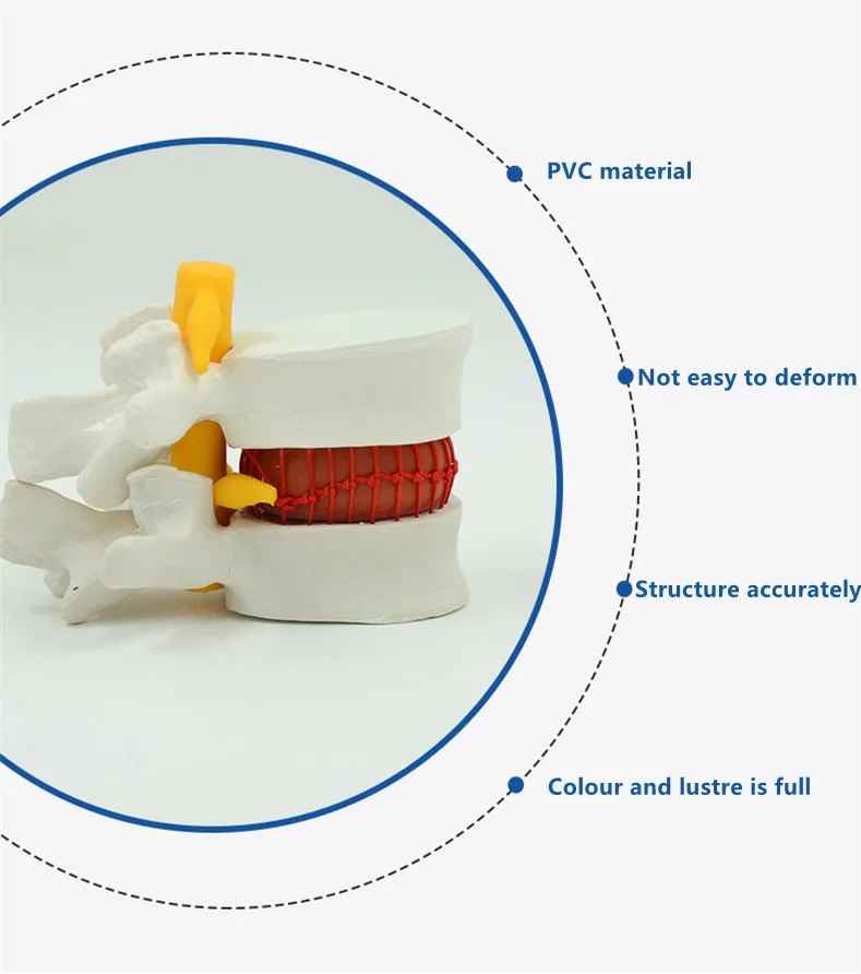 Lumbar Intervertebral Disc Spine Model Extrusion Simulation Spine Model ...
