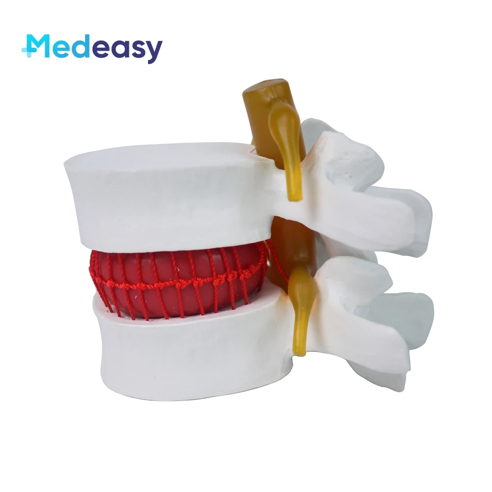 Lumbar Disc Herniation Model - Educational Anatomical Tool