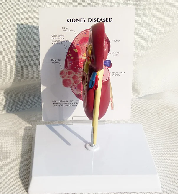 Medical Anatomy Pathological Research Models High-quality Kidney ...