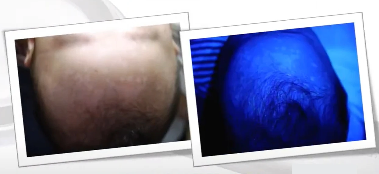 Facial Skin Analyzer with Wood Lamp - Medical Dermatology