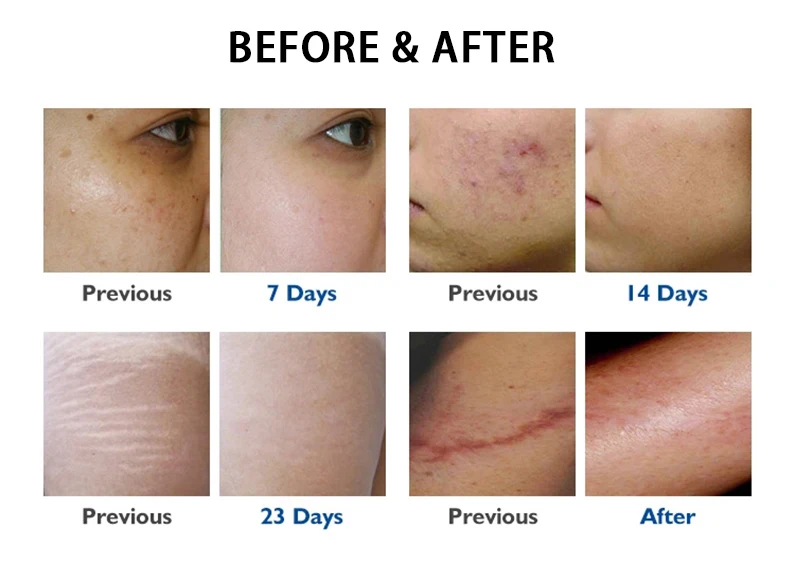 Vaginal Tightening Co2 Fractional Laser Machine Acne Scar Removal Skin ...