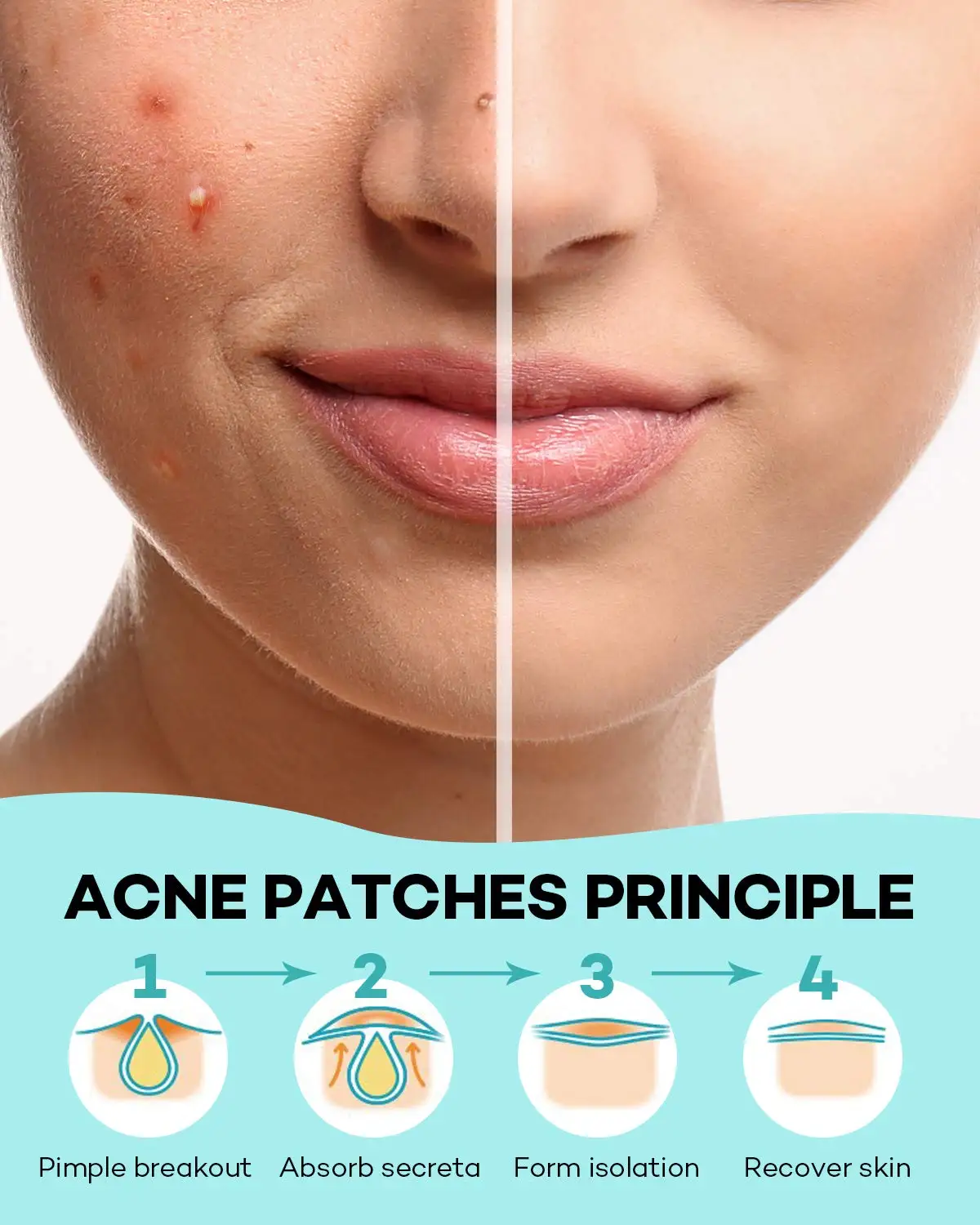 Acne Pimple Patch - Blemish Clearing Hydrocolloid Patch