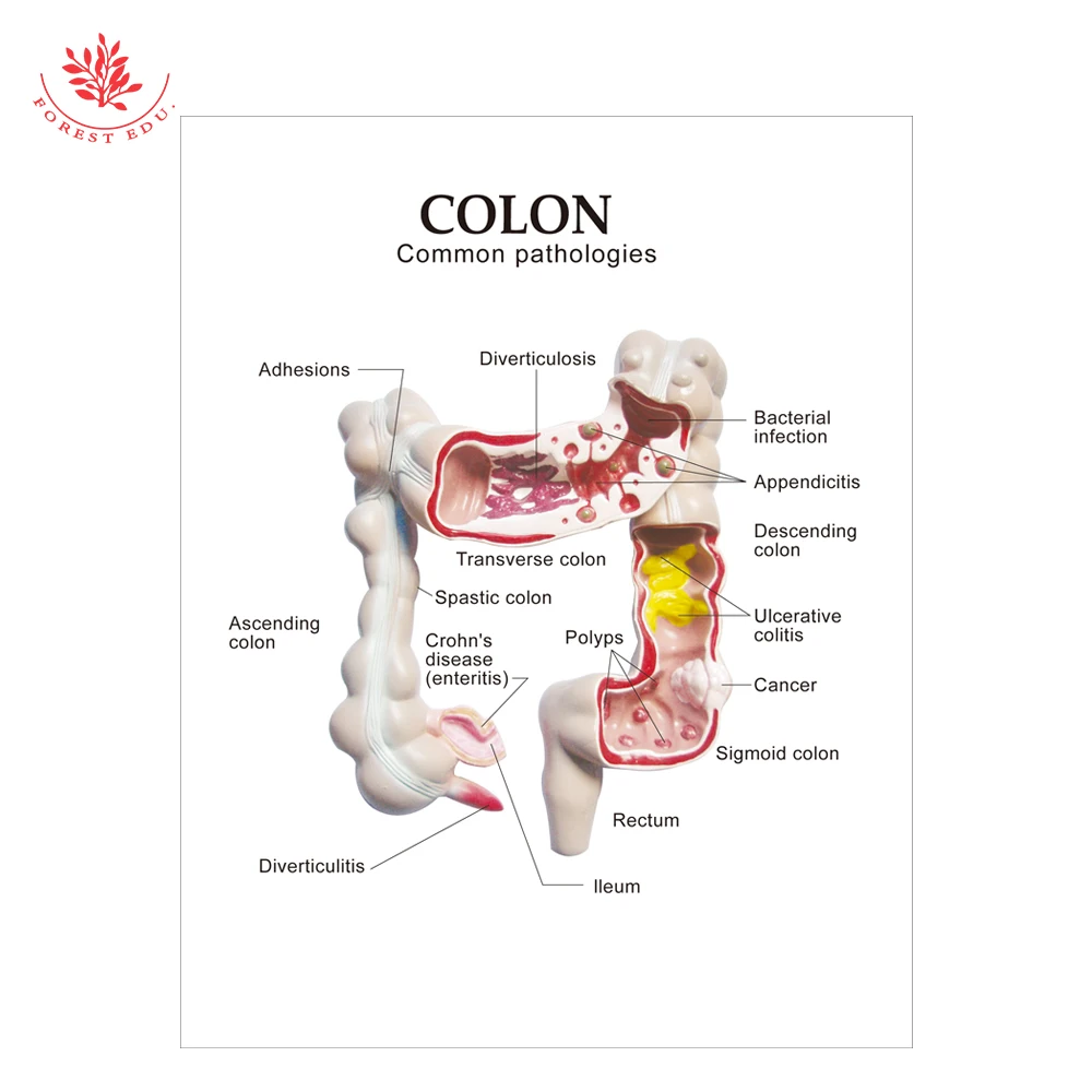Colon Comprehensive Pathology Model Gastrointestinal System Pathology ...