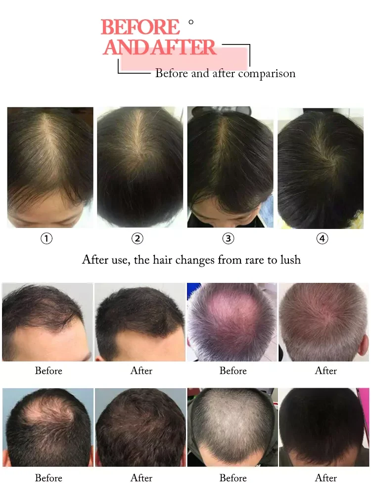 Professional Vertical Anti Hair Loss Treatment 650nm Hair Growth ...