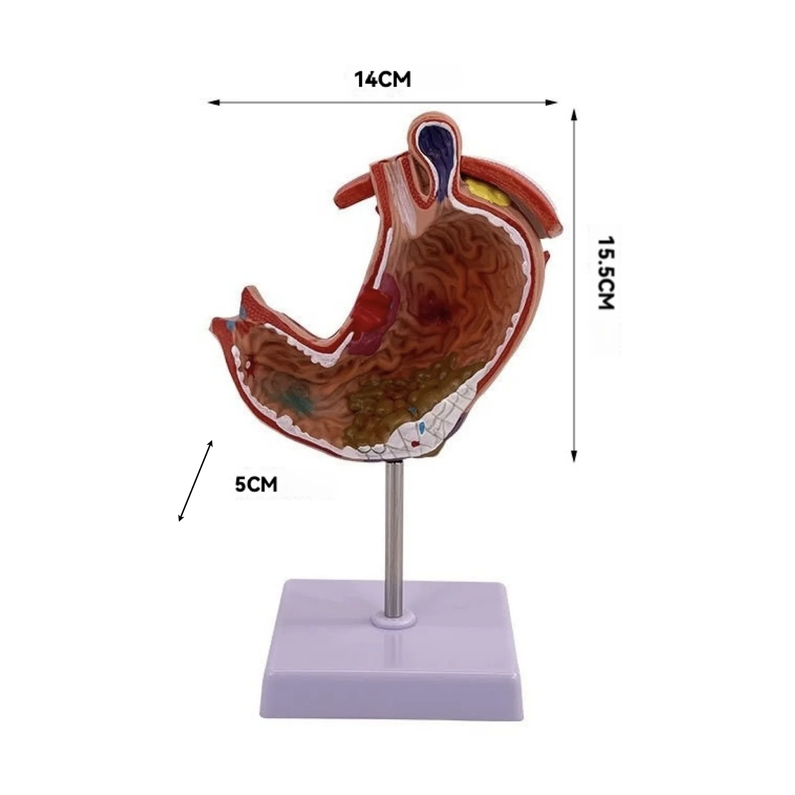 KyrenMed Stomach with Gastric Ulcers Model Pathological Human Stomach ...