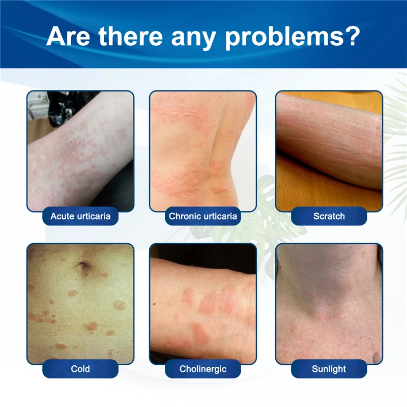 South Moon Urticaria Cream Bacteria Inhibiting Itching Relieving ...
