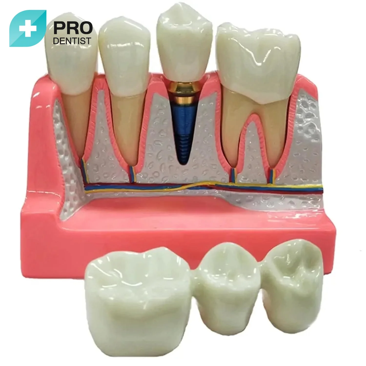 Dental Model ,Implant Model Dental Implants,Crown Bridge Dental Model ...
