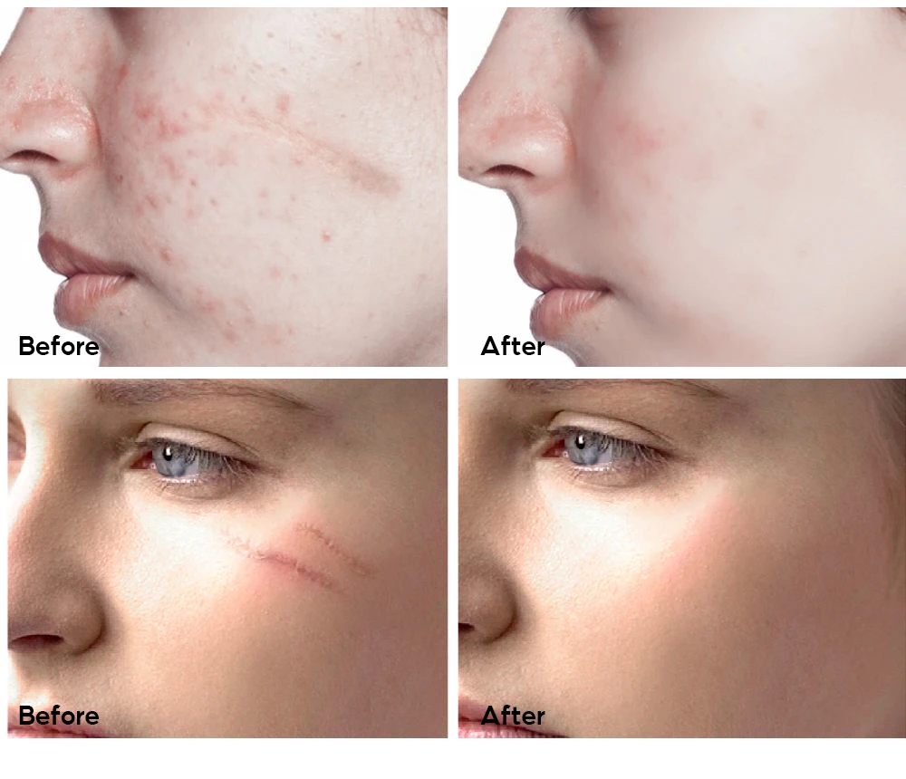 Private Label Facial Treatment Acne Scar Repair With Aloe Vera Gel ...