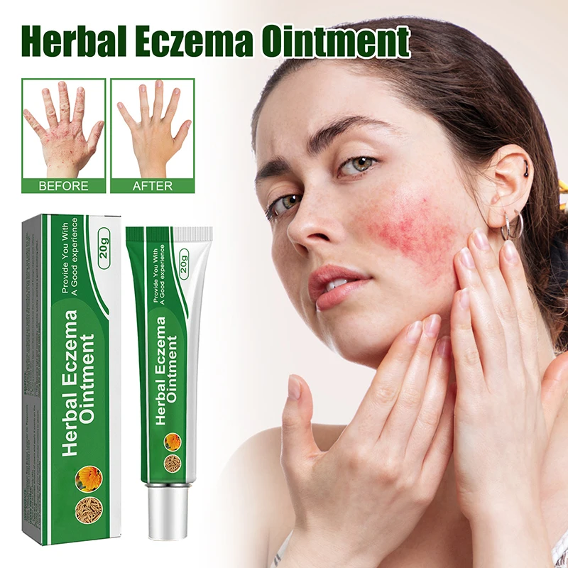 Psoriasis Herbal Ointment Acne Dermatitis Scrotum Eczema Pityriasis ...