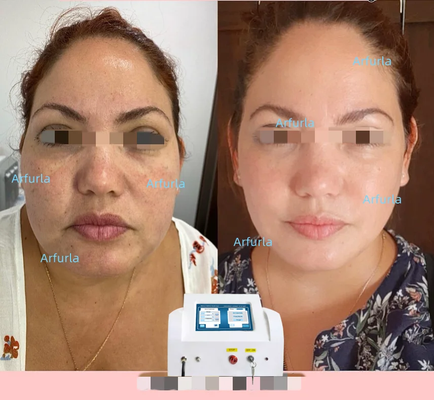 980nm+1470nm Endolifting Laser Lipolysis Device Endoscopic Fat ...