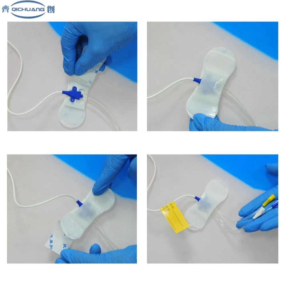IV Cannula Fixing - Reliable PICC CVC Stabilization Paste