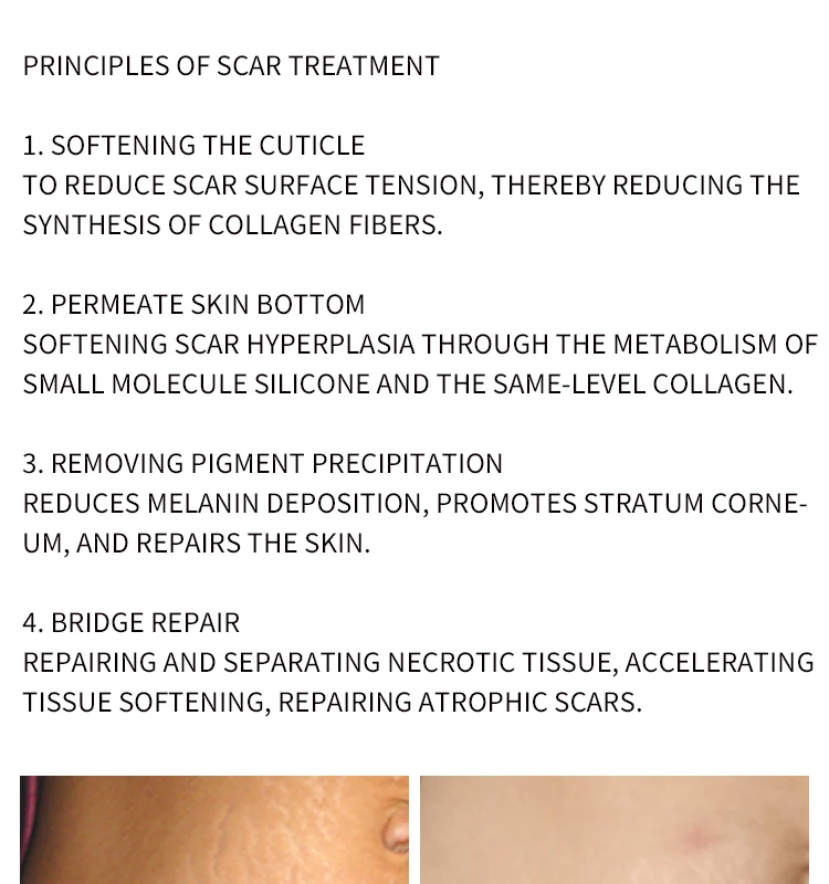 Strong Effective Acne Scar Removal Cream Pimples Stretch Mark Remove ...