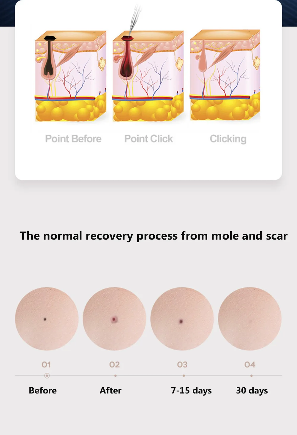 Alibaba.com: Cryo Pen portable skin spot mole removal device, CE/ISO ...