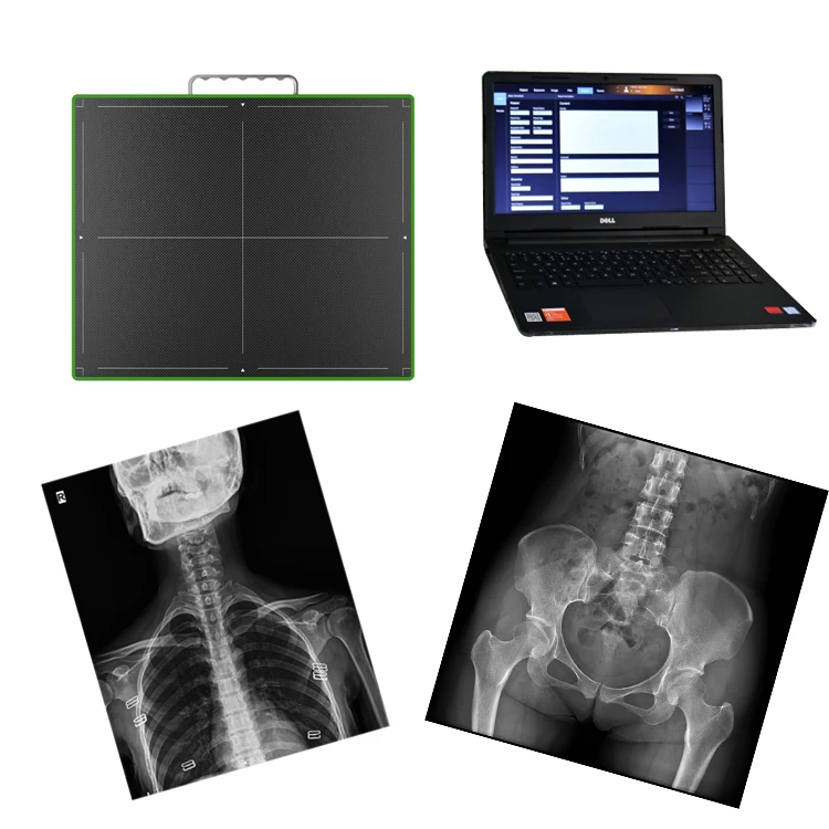 Digital Radiography 17*17 Digital Wireless X-ray Flat Panel Detector ...