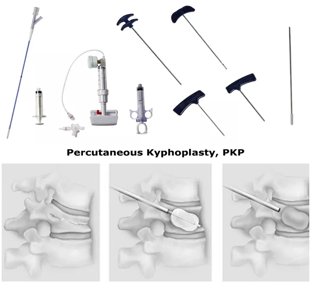 Spine Orthopedic PKP/PVP Kyphoplasty Balloon Catheter Set