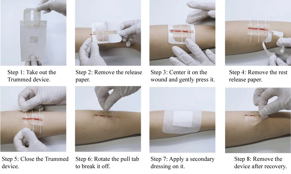 Trummed Medical Zip Stitches - Non-Invasive Wound Closure