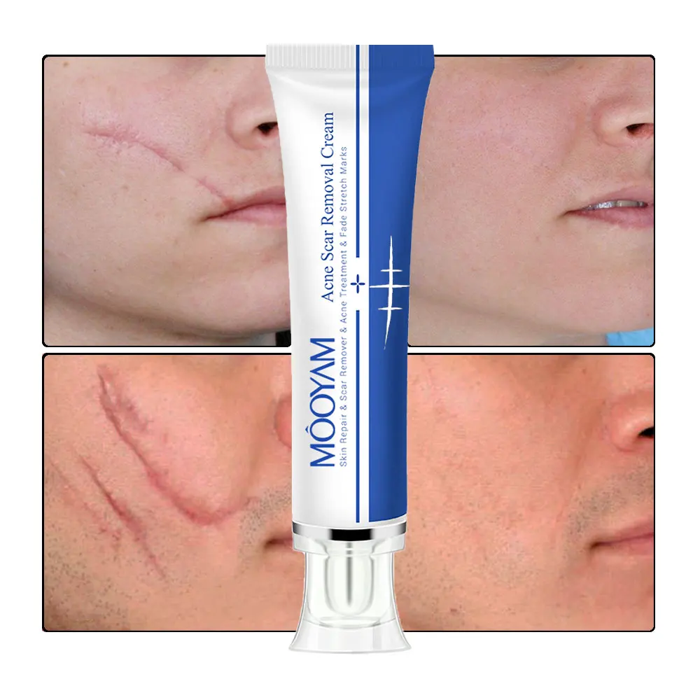 Effective Scar Removal Cream - Acne, Pimples, & Stretch Marks