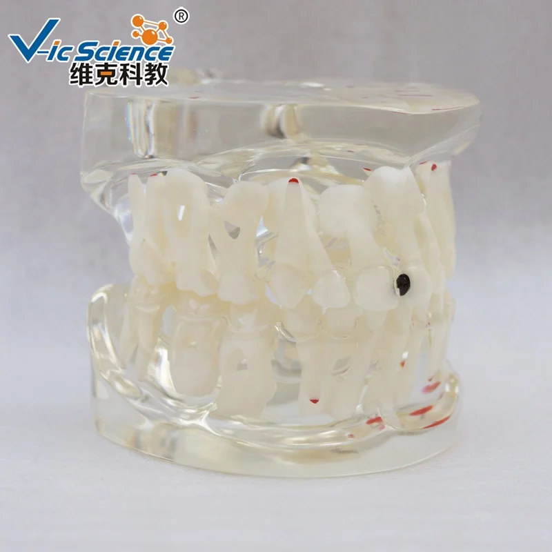 Anatomical Model Of Deciduous Permanent Teeth With Alternating Caries ...