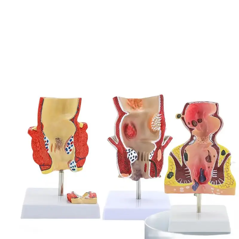 Rectal Hemorrhoids Colorectal Disease Model Internal And External
