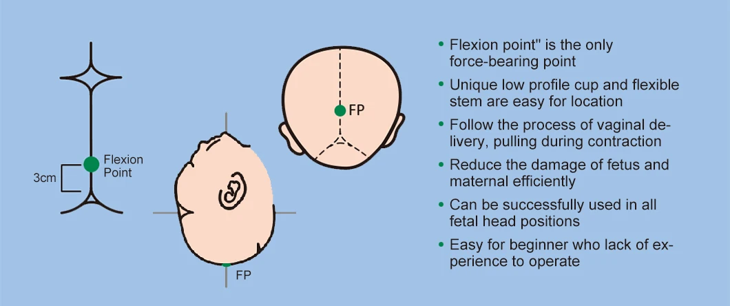 Disposable Fetal Head Vacuum Extraction Delivery System | Manual ...