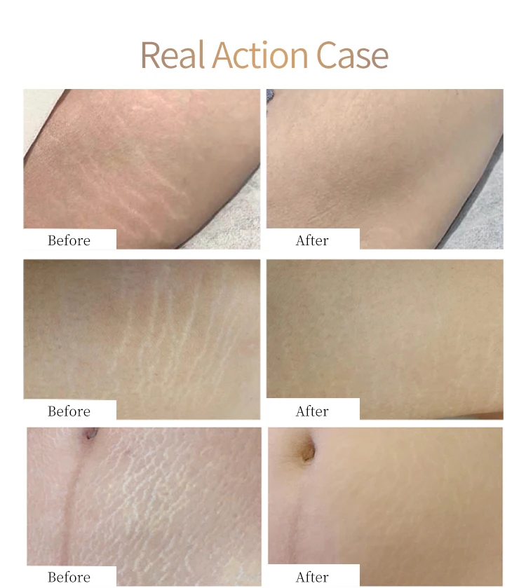 GINZO Vitiligo Treatment Permanent Makeup Skin Pigment Stretch Mark ...