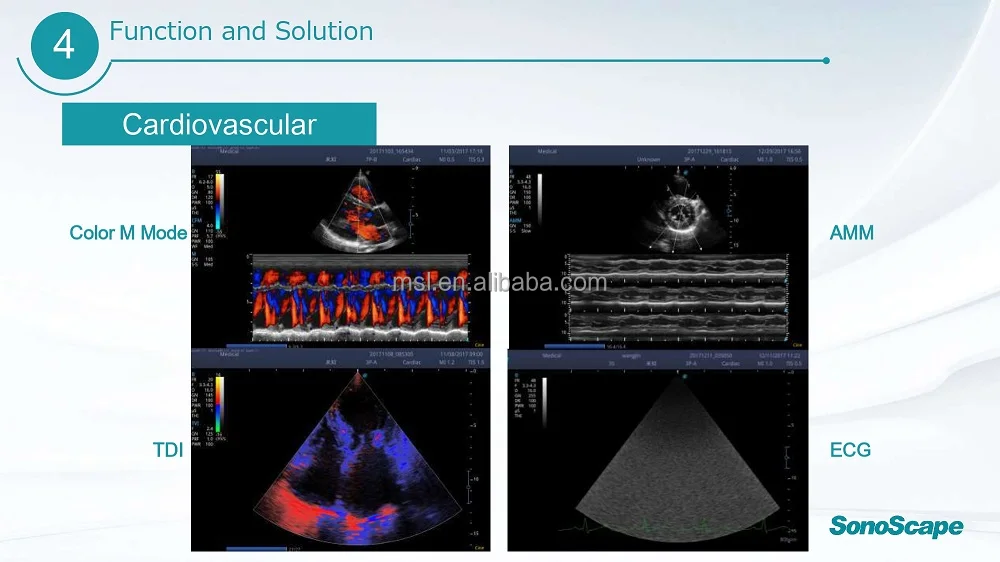 Sonoscape E2 3D 4D Ultrasound - Advanced OB/GYN Diagnostics