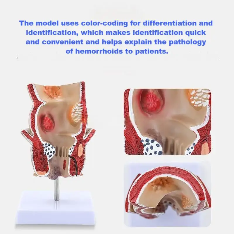 Medical Anatomical Hemorrhoid Model for Pathological Demonstration ...