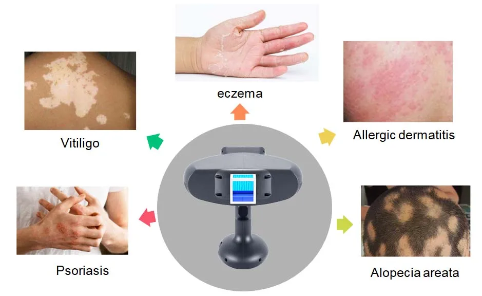 Excimer Laser Vitiligo Machine - Mini Psoriasis Treatment