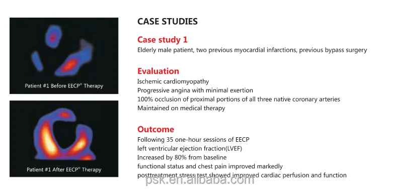 Vasomedical Lumenair Eecp-Machine Rehabilitation Device