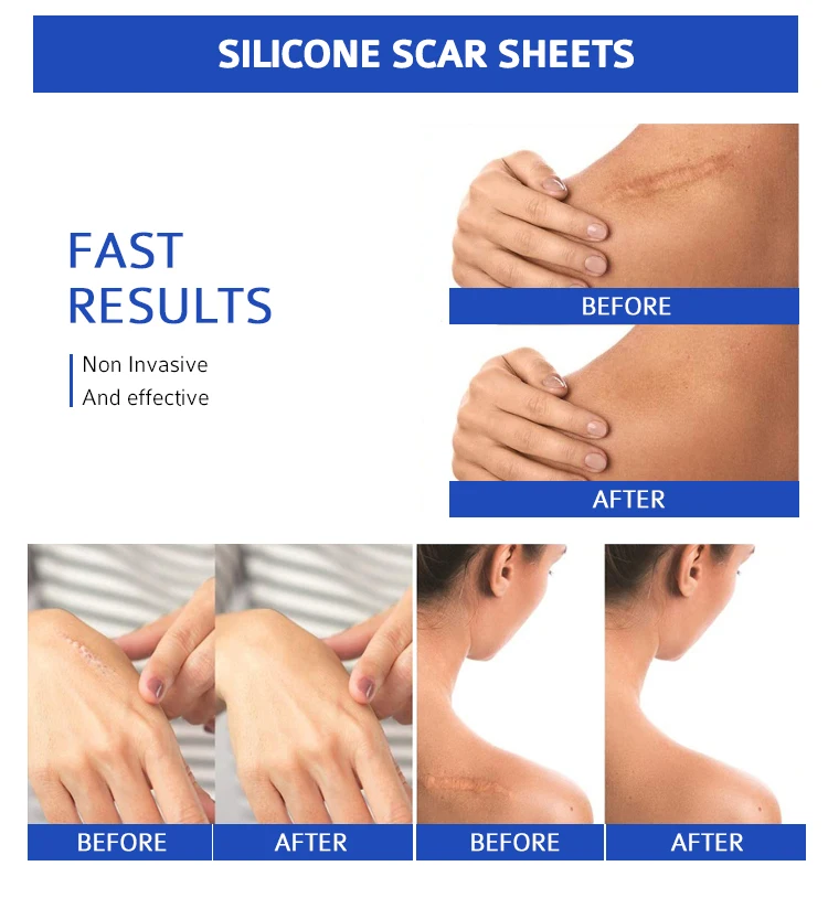 Advanced Easy-tear Silicone Strips Painless Scar Removal Patch Curad ...