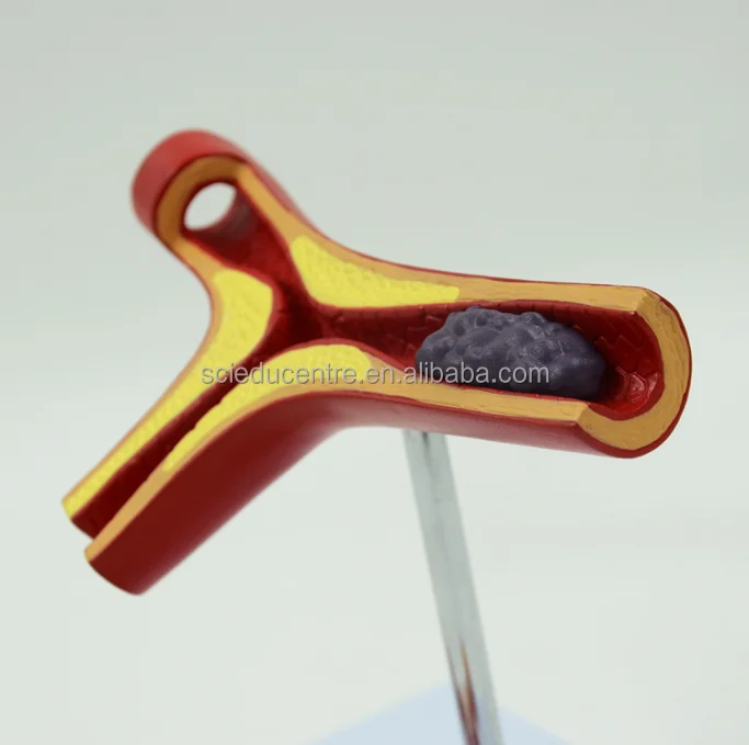 Educational Anatomy Human Arterial Thrombosis and Sclersis Coaching ...