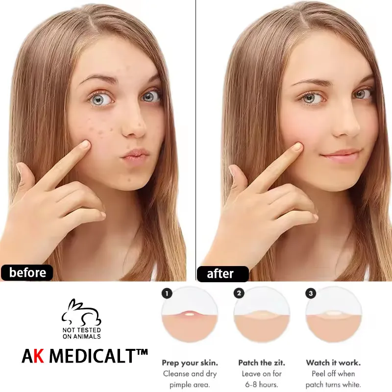 Customize Medical Spot Sticker Hydrocolloid Acne Pimple Cover Patch ...