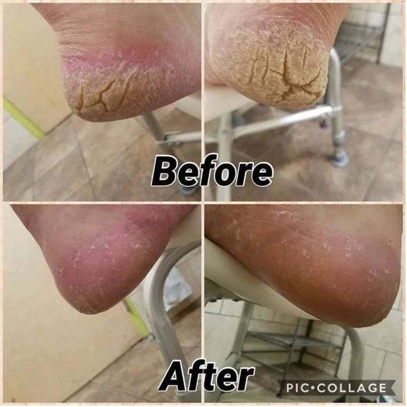 Anti Fungal Foot Repair Foot Scrub Exfoliation Dead Skin Removal ...