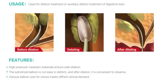 Digestive Esophageal Balloon Dilation Balloon For Esophagus,Pylorus And ...