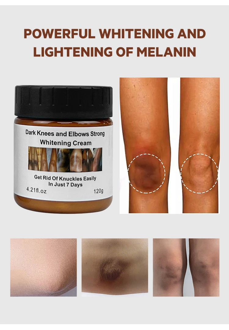 Wholesale Dark Kness Knuckles Whitening Cream For Removing Dark ...