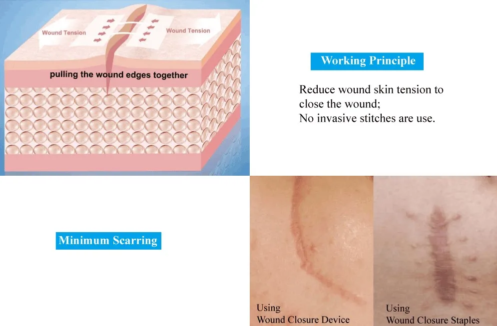 Trummed Medical Zipper - Wound Closure Without Stitches