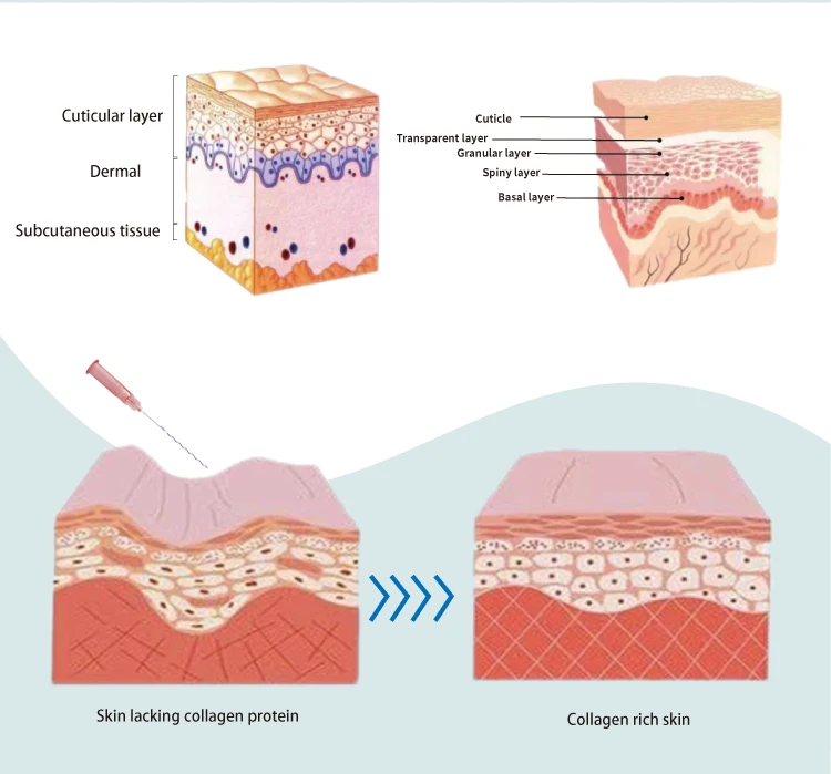 Beauty Injection Pdo Thread Facelift Face Lifting Thread Pdo 19g100mm ...